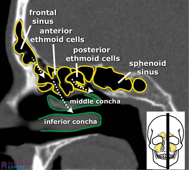 Ct Sinus